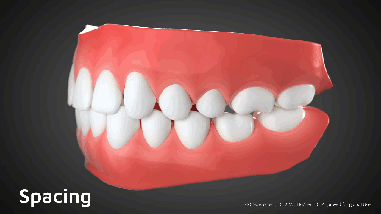 Types of Malocclusion – ClearCorrect Support