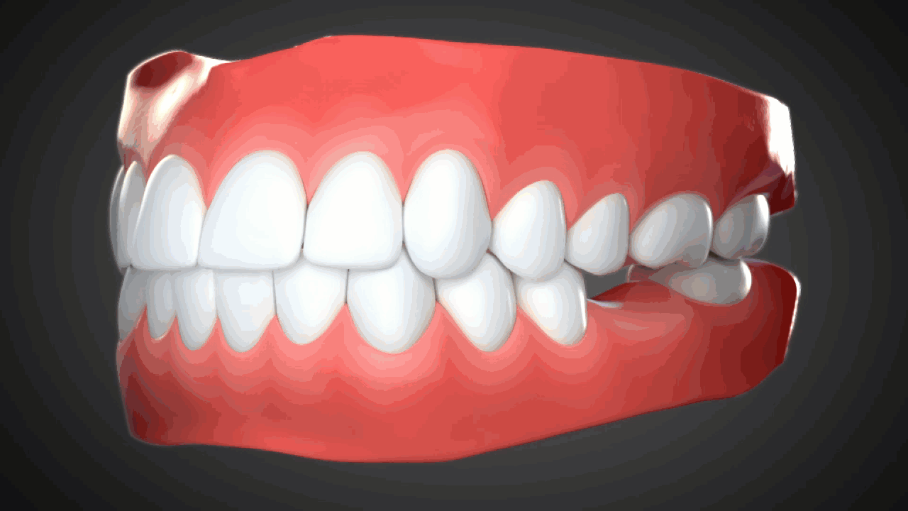 Pontics and Bars – ClearCorrect Support