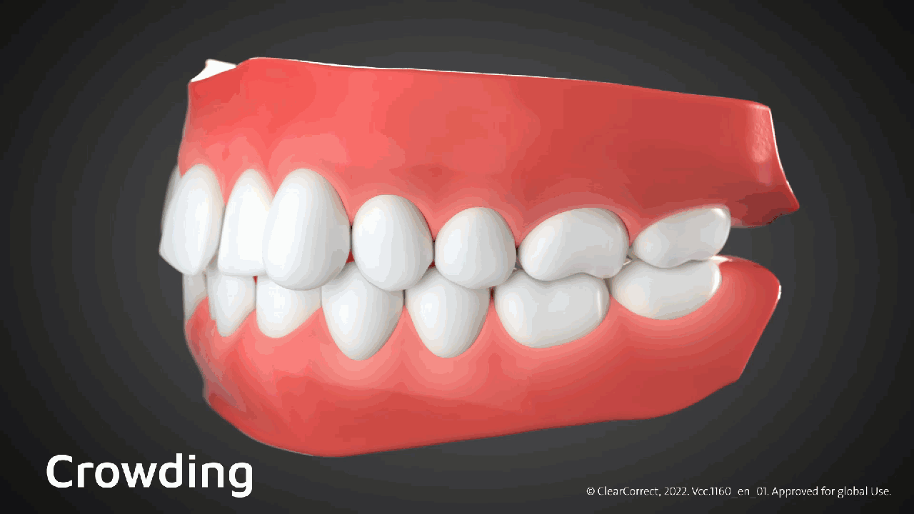 Types of Malocclusion – ClearCorrect Support