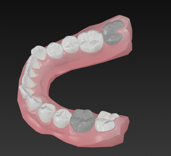 Pontics and Bars - Support