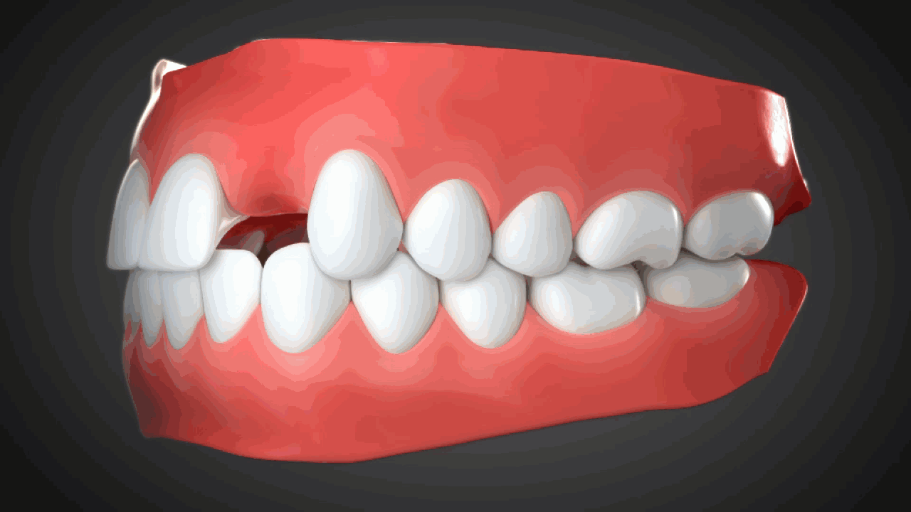 Pontics and Bars – ClearCorrect Support