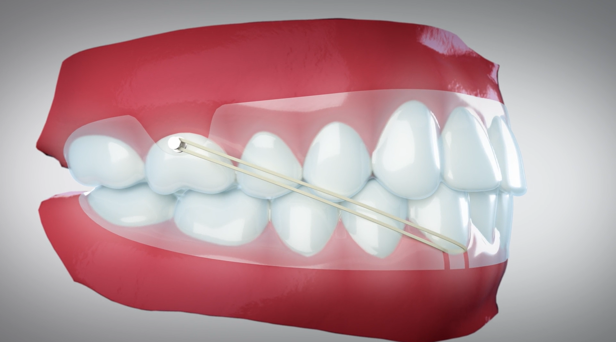 Treatment Preferences – ClearCorrect Support