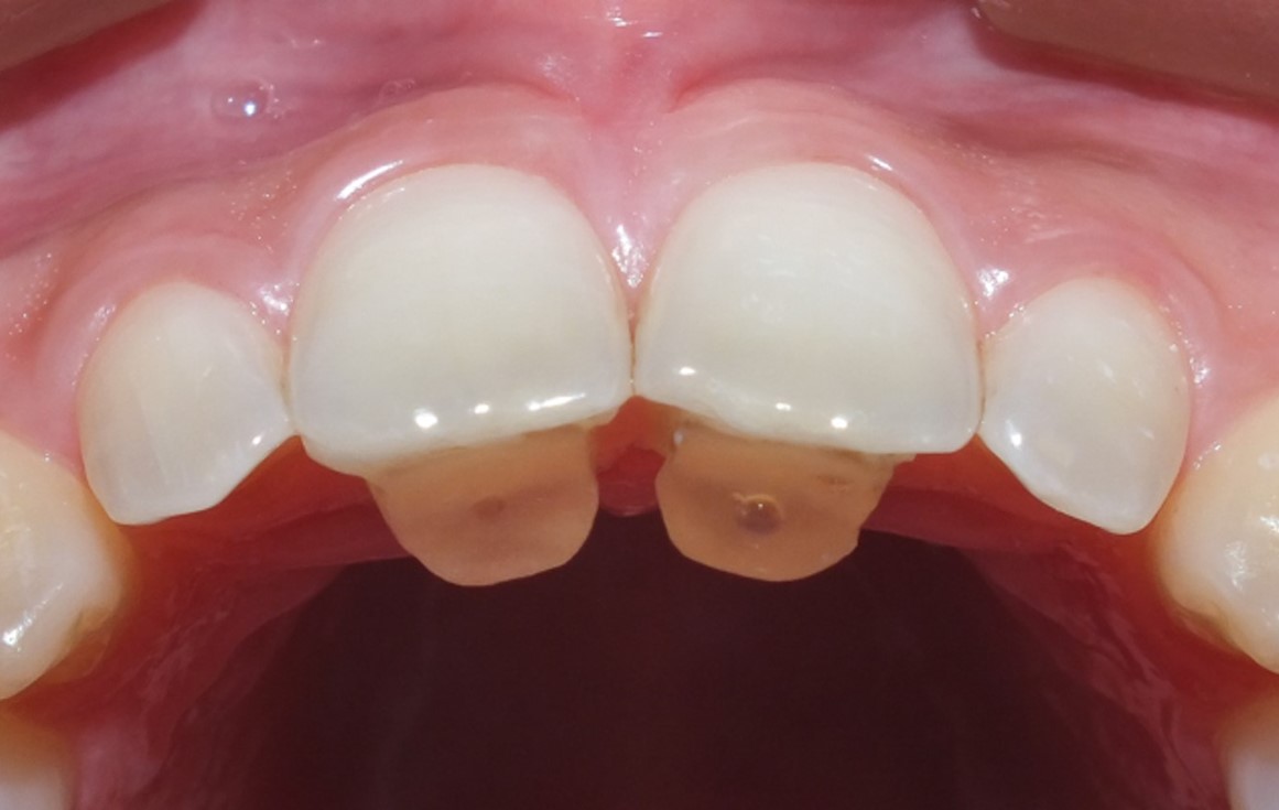 Bite Ramps – ClearCorrect Support