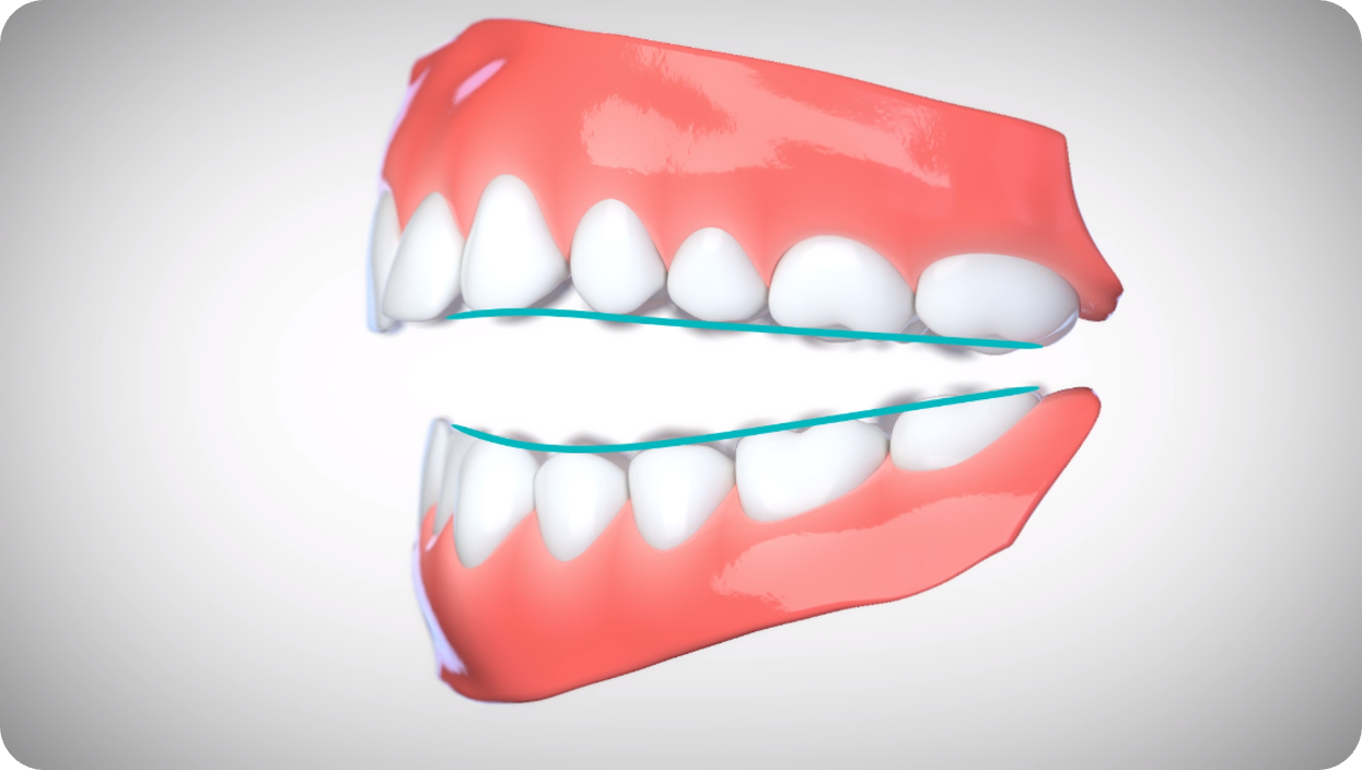 Bite Ramps – ClearCorrect Support
