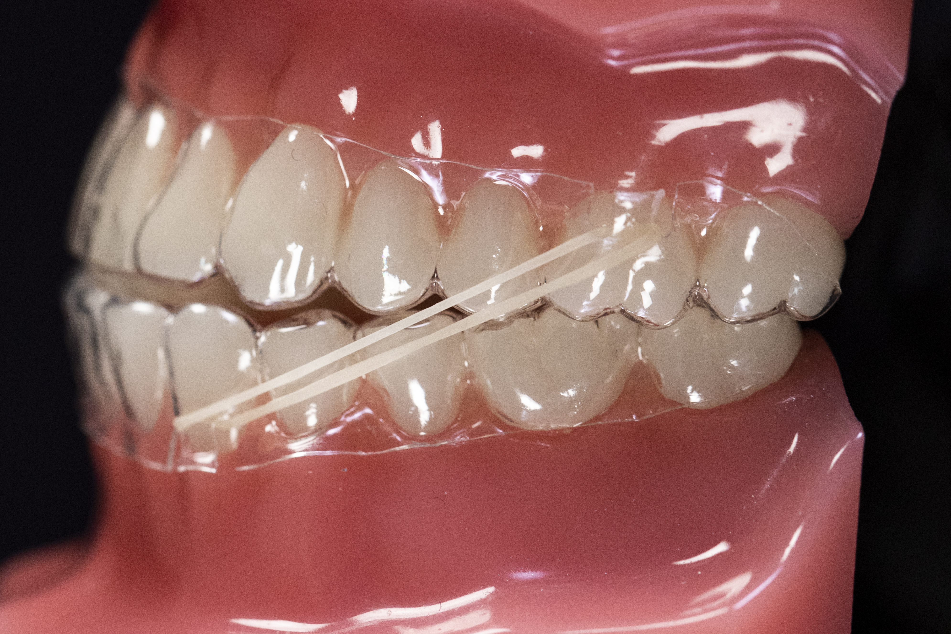 How to Use Slit Cutouts with Aligners – ClearCorrect Support