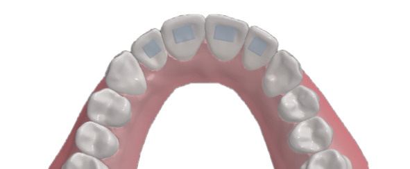 Bite Ramps – ClearCorrect Support