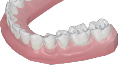 Bite Ramps – ClearCorrect Support