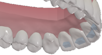 Bite Ramps – ClearCorrect Support