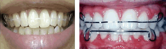 Types of Retainers – ClearCorrect Support