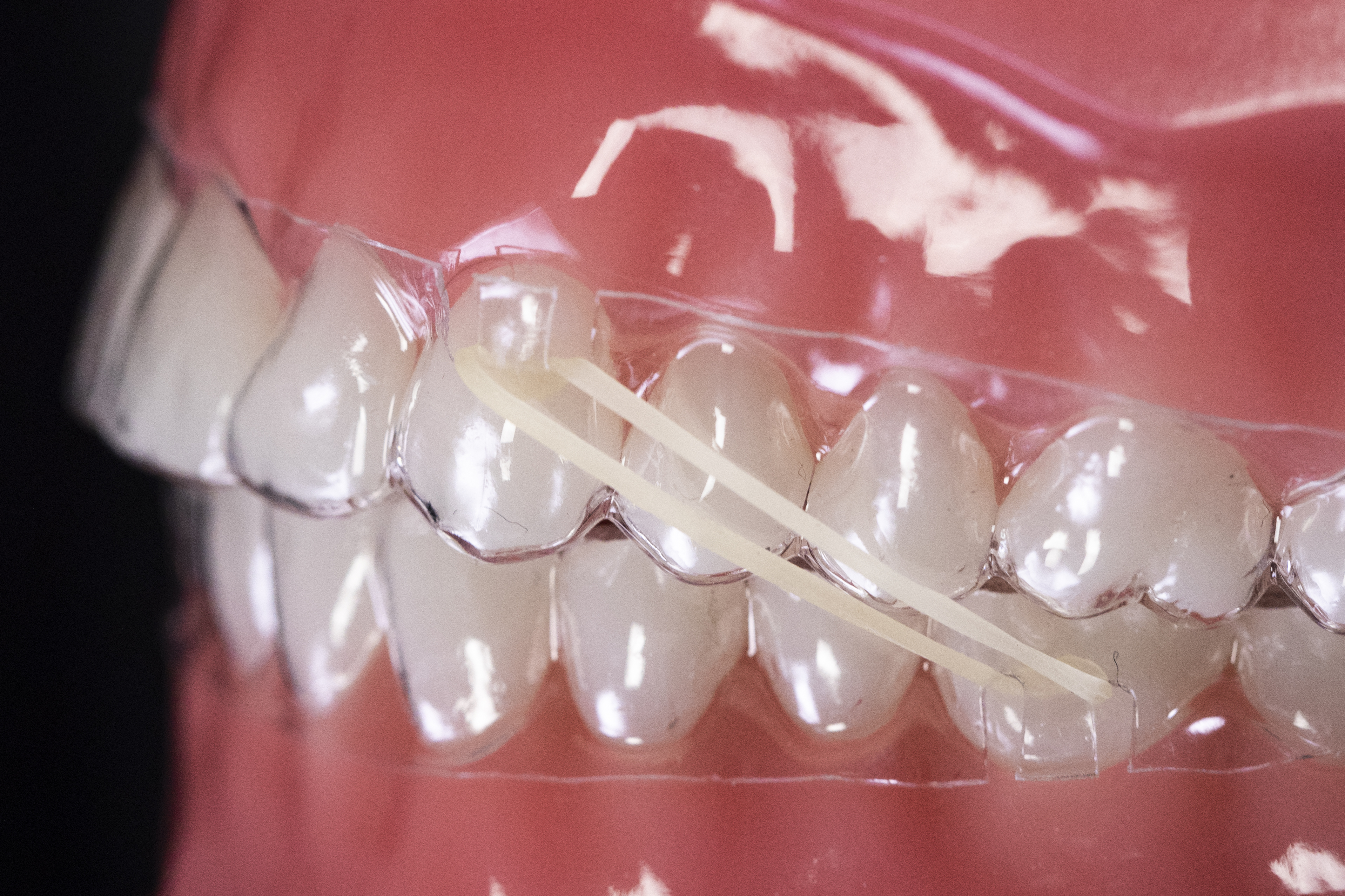 Aligner Cutouts ClearCorrect Support