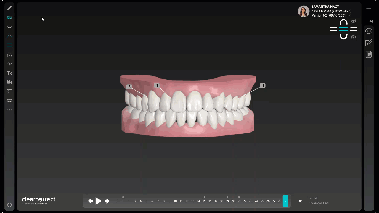 ClearPilot™ - Using the Dr. Edits 3D Controls Tool – ClearCorrect Support