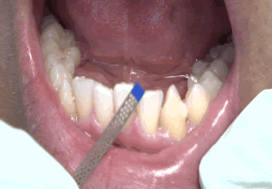 IPR - How to Perform – ClearCorrect Support