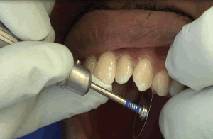 IPR - How to Perform – ClearCorrect Support