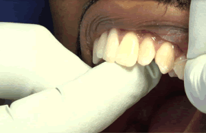 IPR - How to Perform – ClearCorrect Support