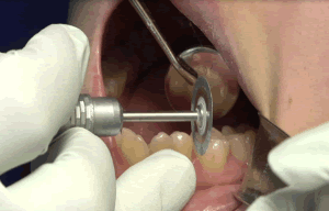 IPR - How to Perform – ClearCorrect Support