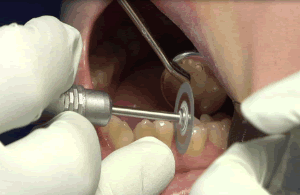 IPR - How to Perform – ClearCorrect Support