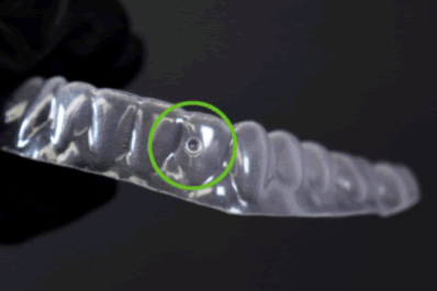 Dimples - Where to place – ClearCorrect Support