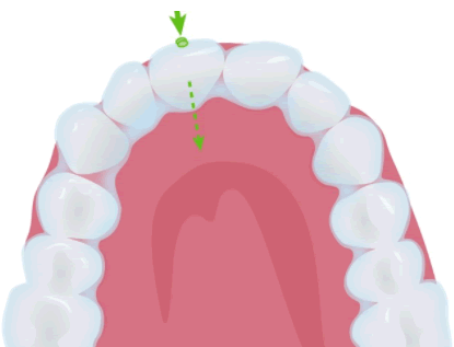 Dimples - Where to place – ClearCorrect Support