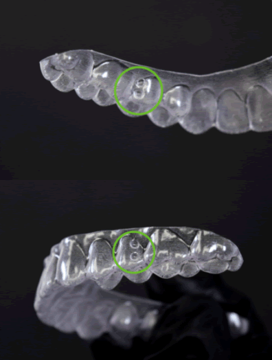 Dimples - Where to place – ClearCorrect Support