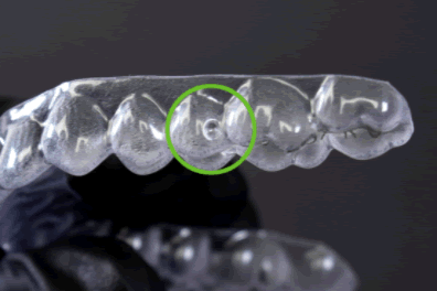 Dimples - Where to place – ClearCorrect Support