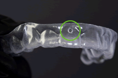 Dimples - Where to place – ClearCorrect Support