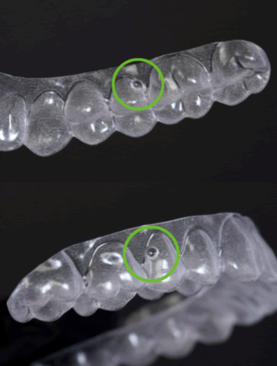 Dimples - Where to place – ClearCorrect Support