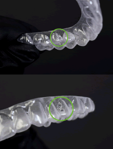 Dimples - Where to place – ClearCorrect Support